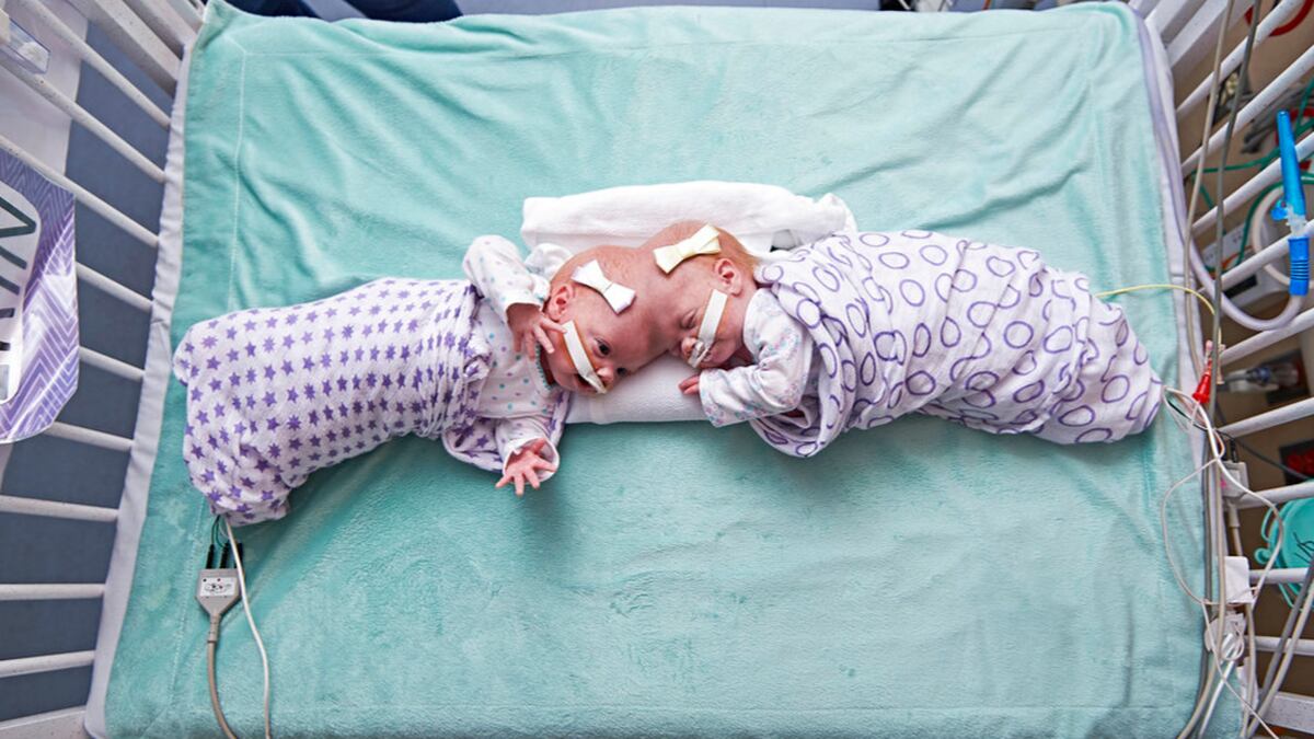 10-month-old conjoined twins in North Carolina successfully separated